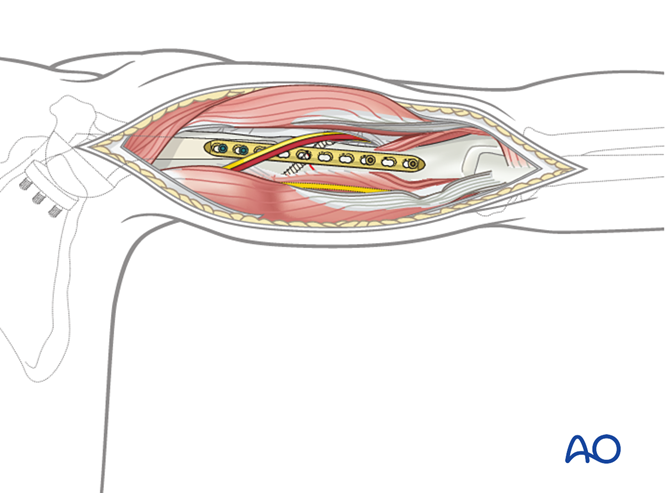 ORIF - Lag screw with plate fixation for Fracture distal to the implant