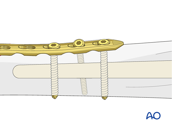 ORIF - Lag screw with plate fixation for Fracture distal to the implant