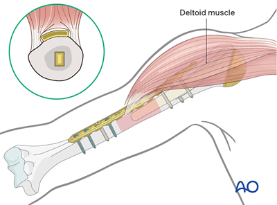 ORIF - Bridge plate fixation for Humeral implant stable, good bone