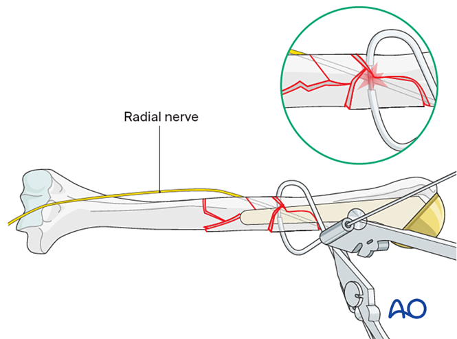 ORIF - Bridge plate fixation for Humeral implant stable, good bone