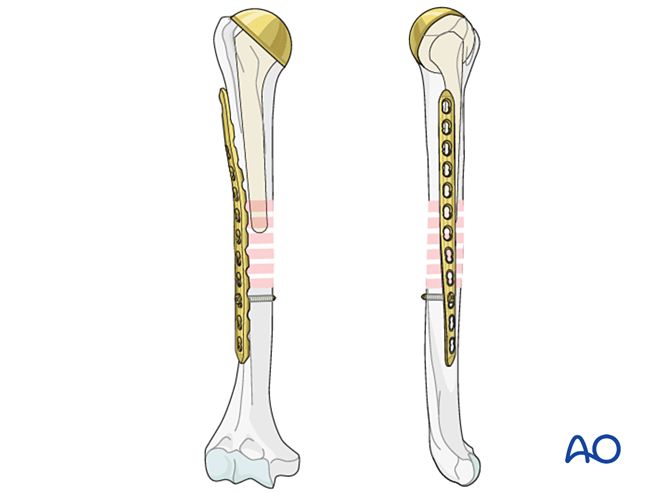 ORIF - Bridge plate fixation for Humeral implant stable, good bone