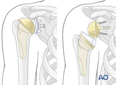 Revision of an anatomic all polyethylene glenoid component for Glenoid ...
