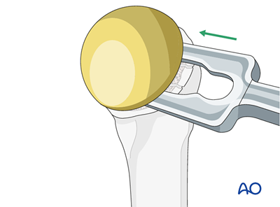 Revision of an anatomic metal-backed glenoid component for Glenoid ...