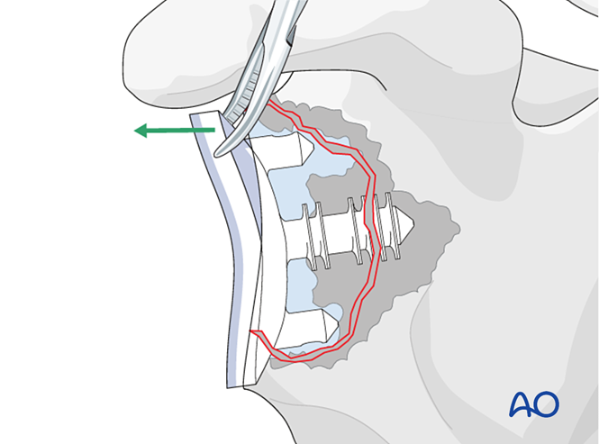 Revision of an anatomic all polyethylene glenoid component for Glenoid ...