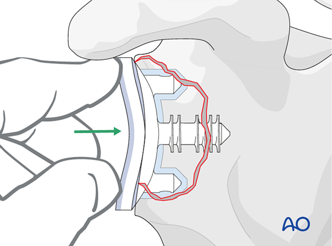 Revision of an anatomic all polyethylene glenoid component for Glenoid ...