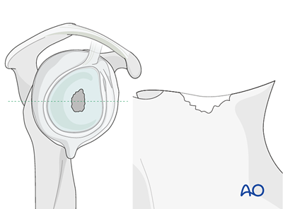 Revision of an anatomic all polyethylene glenoid component for Glenoid ...