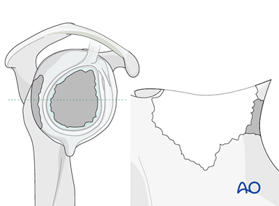 Revision of an anatomic all polyethylene glenoid component for Glenoid ...