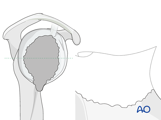 Revision of a reverse glenoid baseplate for Glenoid implant loose poor ...