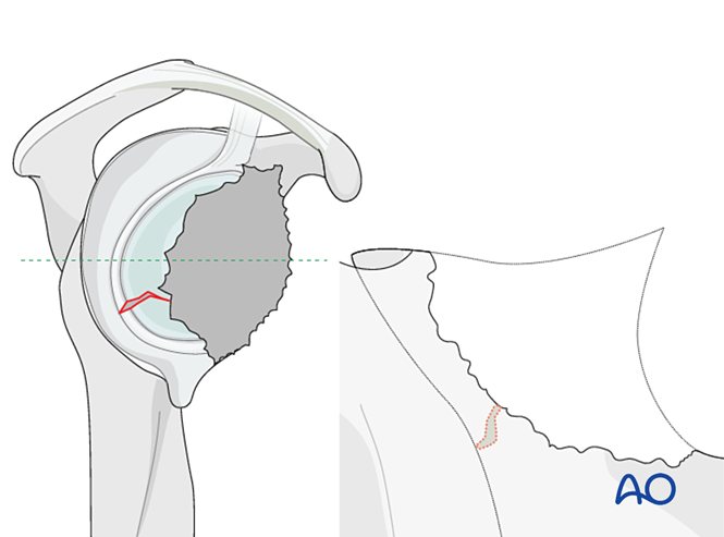 Revision of an anatomic all polyethylene glenoid component for Glenoid ...