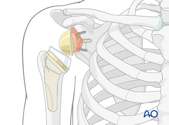 Revision of an anatomic all polyethylene glenoid component for Glenoid ...