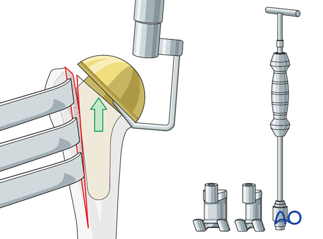 Revision of an anatomic all polyethylene glenoid component for Glenoid ...