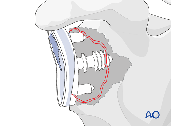 Revision of a hybrid glenoid component for Glenoid implant loose good bone