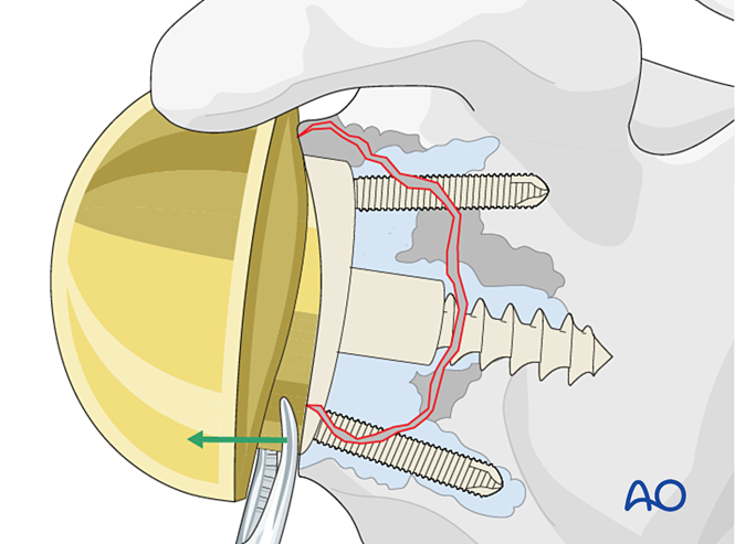 Revision of a reverse glenoid baseplate for Glenoid implant loose poor ...