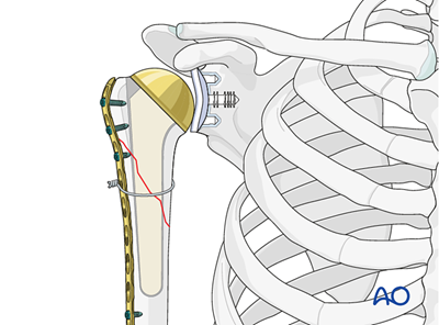 Revision of a standard stem for Humeral implant loose, good bone