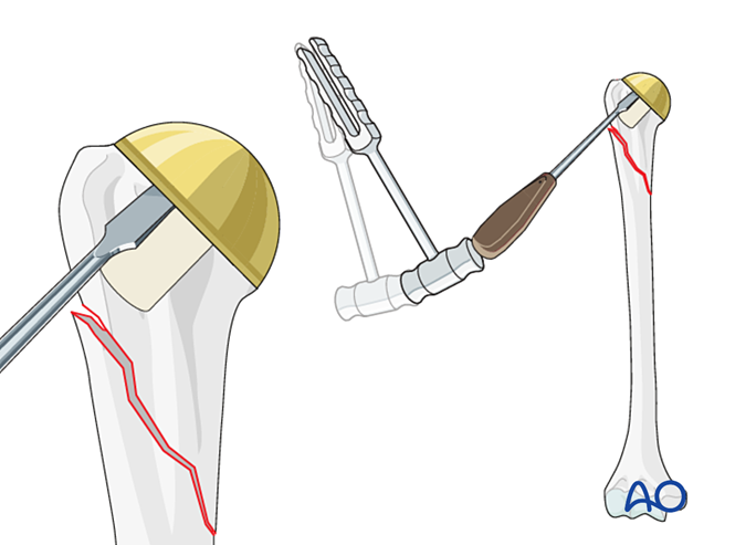 Revision of a stemless implant for Humeral implant loose, good bone