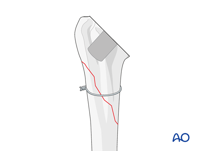 Revision of a stemless implant for Humeral implant loose, good bone