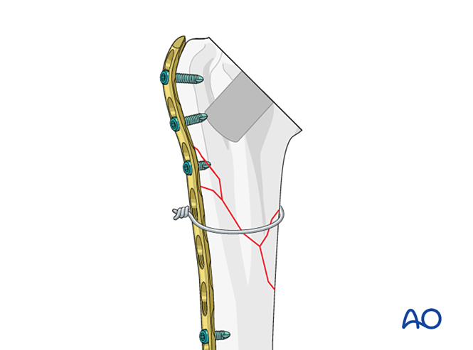 Revision of a stemless implant for Humeral implant loose, poor bone, defect