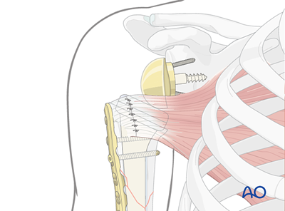 Revision of a standard stem for Humeral implant loose, good bone