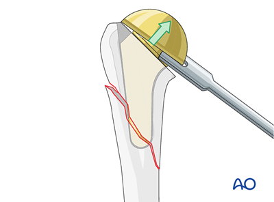 Revision of a short stem for Humeral implant loose, good bone
