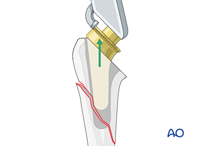 Revision of a short stem for Humeral implant loose, good bone