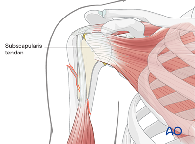 Revision of a short stem for Humeral implant loose, good bone