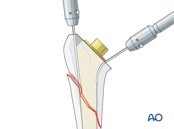 Revision of a standard stem for Humeral implant loose, good bone