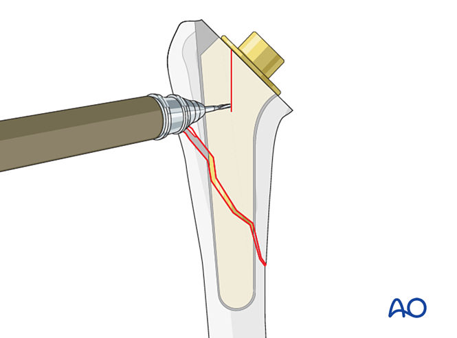 Revision of a standard stem for Humeral implant loose, good bone