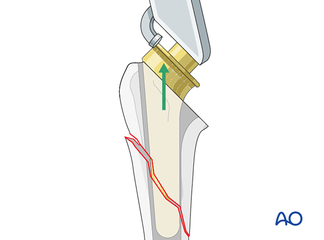 Revision of a standard stem for Humeral implant loose, good bone