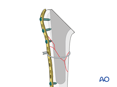 Revision of a standard stem for Humeral implant loose, good bone