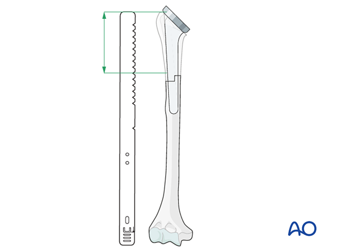 humeral revision with allograft