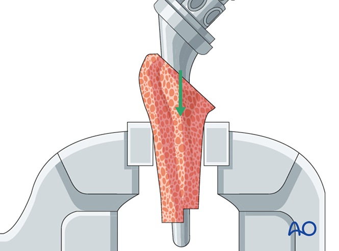 humeral revision with allograft