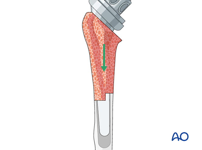 Humeral revision with allograft for Humeral implant loose, good bone