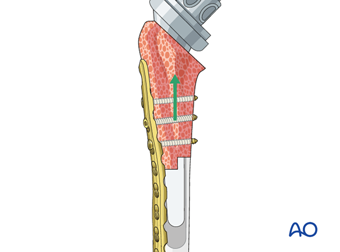humeral revision with allograft