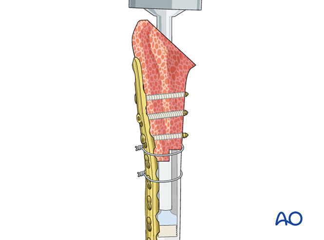 humeral revision with allograft