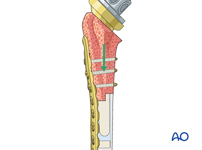 Humeral revision with allograft for Humeral implant loose, good bone
