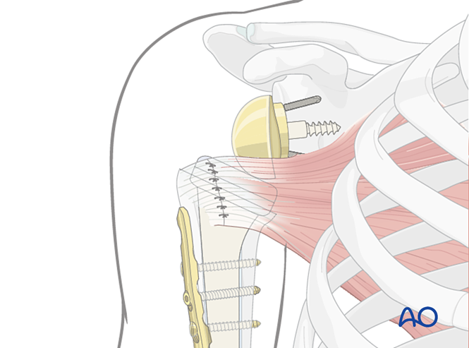 humeral revision with allograft