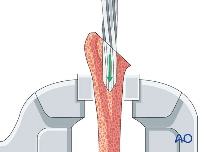 Humeral revision with allograft for Humeral implant loose, good bone