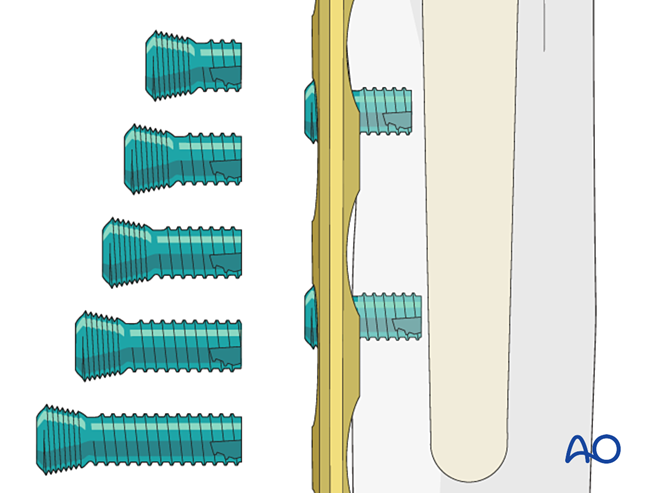 Peri-implant fixation options