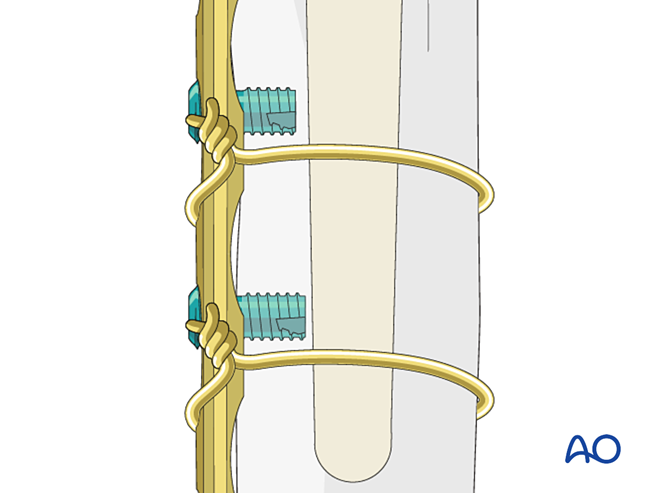 Peri-implant fixation options
