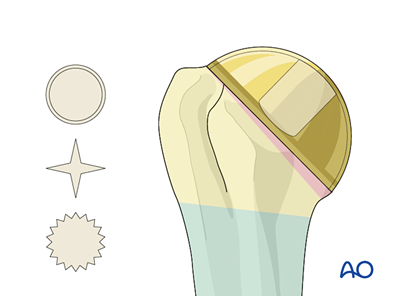 Shoulder implant configurations