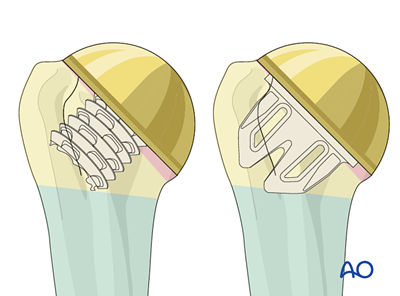 Shoulder implant configurations