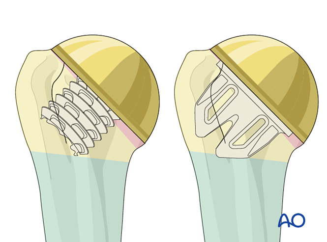 Shoulder implant configurations