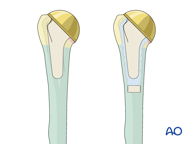 Shoulder implant configurations