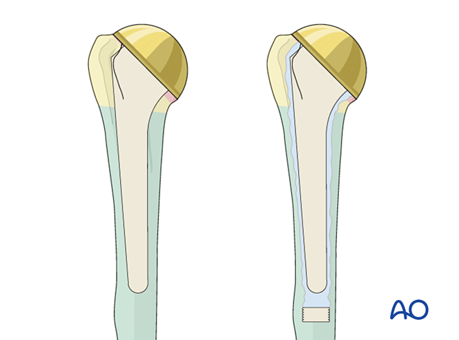Shoulder implant configurations