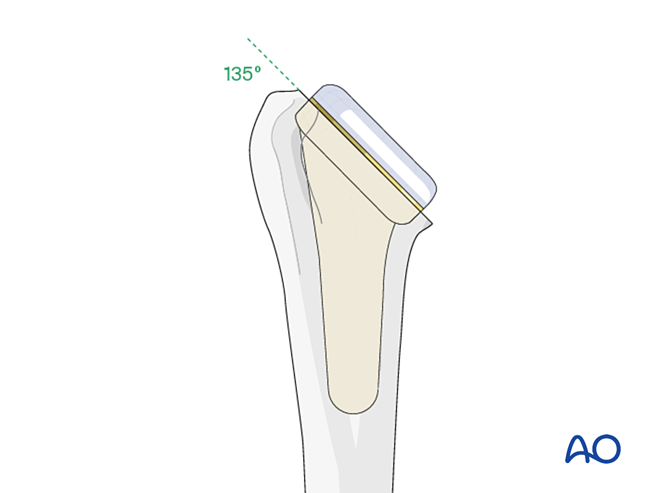 Shoulder implant configurations