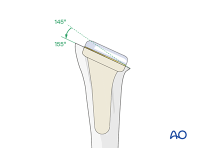 Shoulder implant configurations