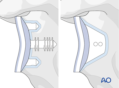 Shoulder implant configurations