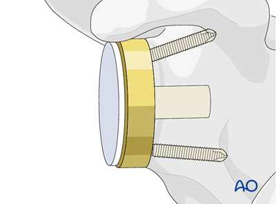 Shoulder implant configurations