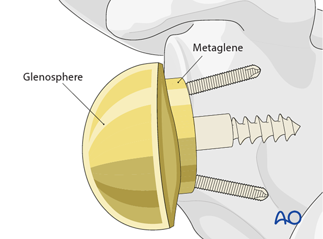 Shoulder implant configurations