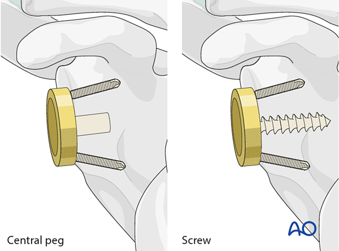 Shoulder implant configurations